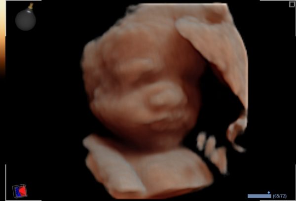 SCAN - Metro IVF Fertility Centre