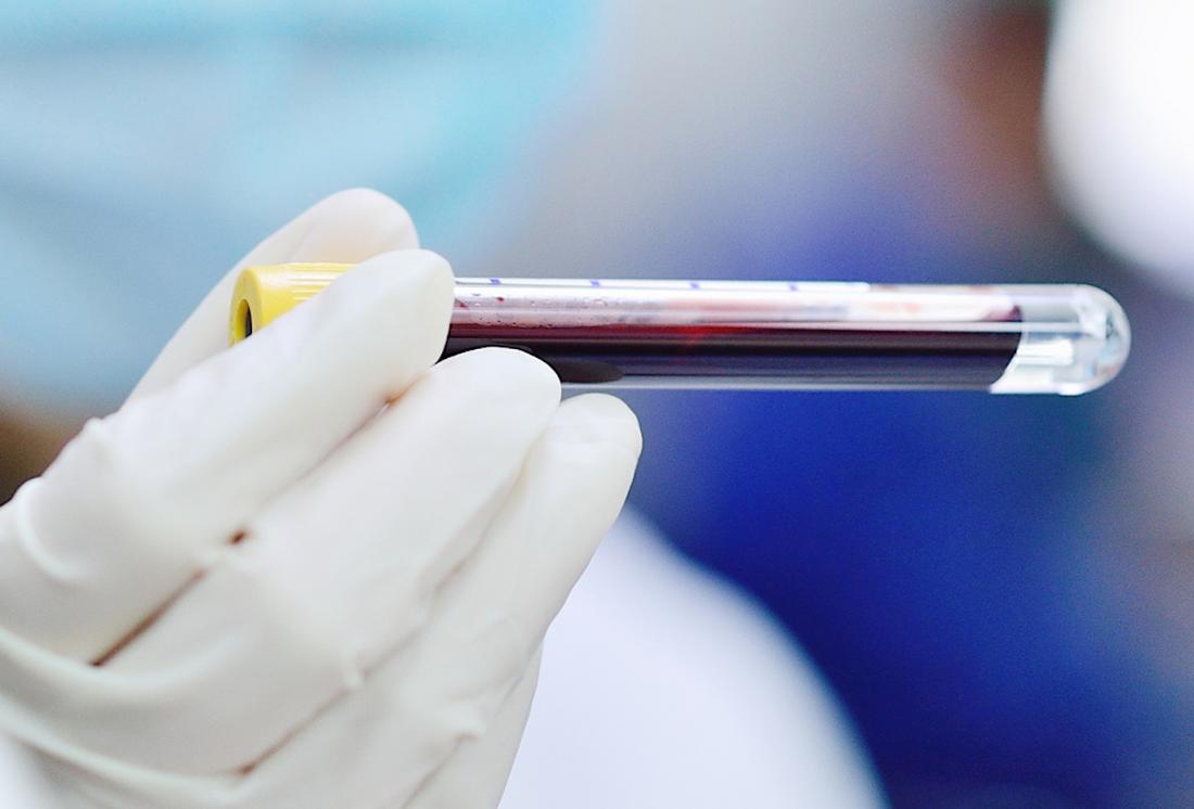 Blood Test - Metro IVF Fertility Centre